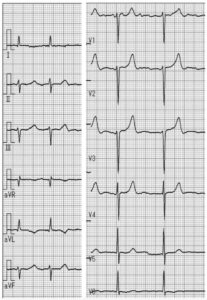 reversed R wave progressionとは？ | 心電図.com