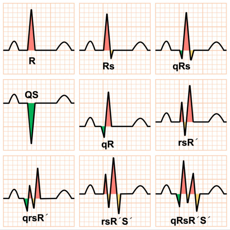 QRS波の命名法とは？ | 心電図.com