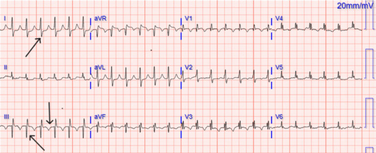 S1Q3T3 patternとは？ | 心電図.com