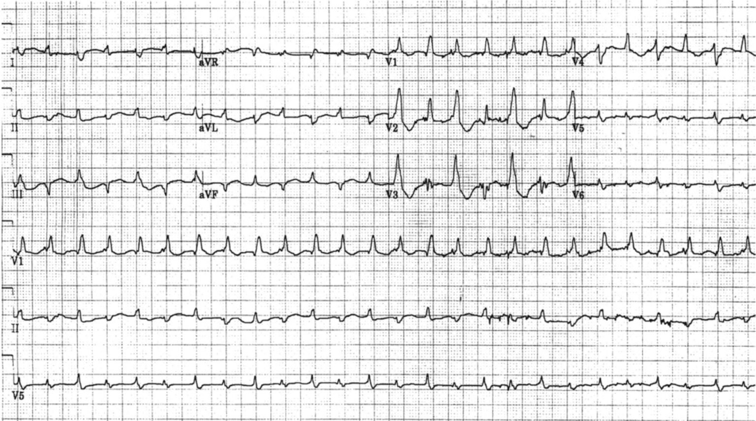 QRS波の命名法とは？ | 心電図.com