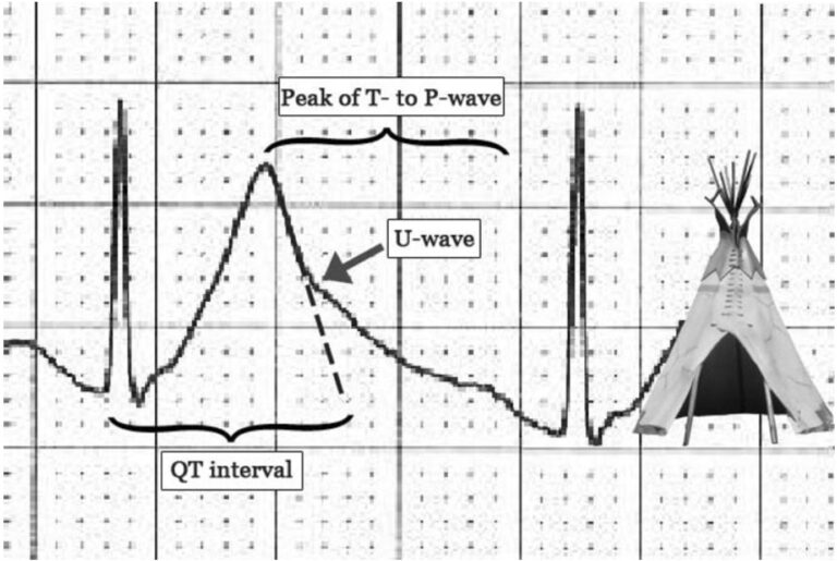 tee-pee signとは? | 心電図.com