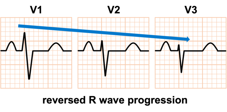 reversed R wave progressionとは？ | 心電図.com