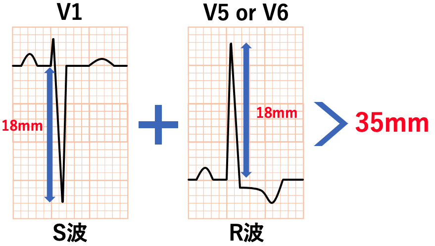 左室肥大とは? | 心電図.com