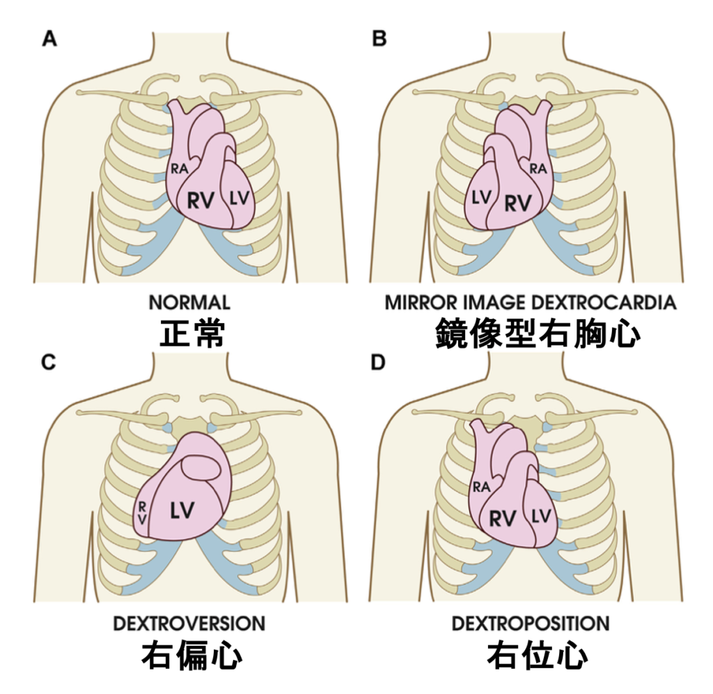 右胸心とは? | 心電図.com