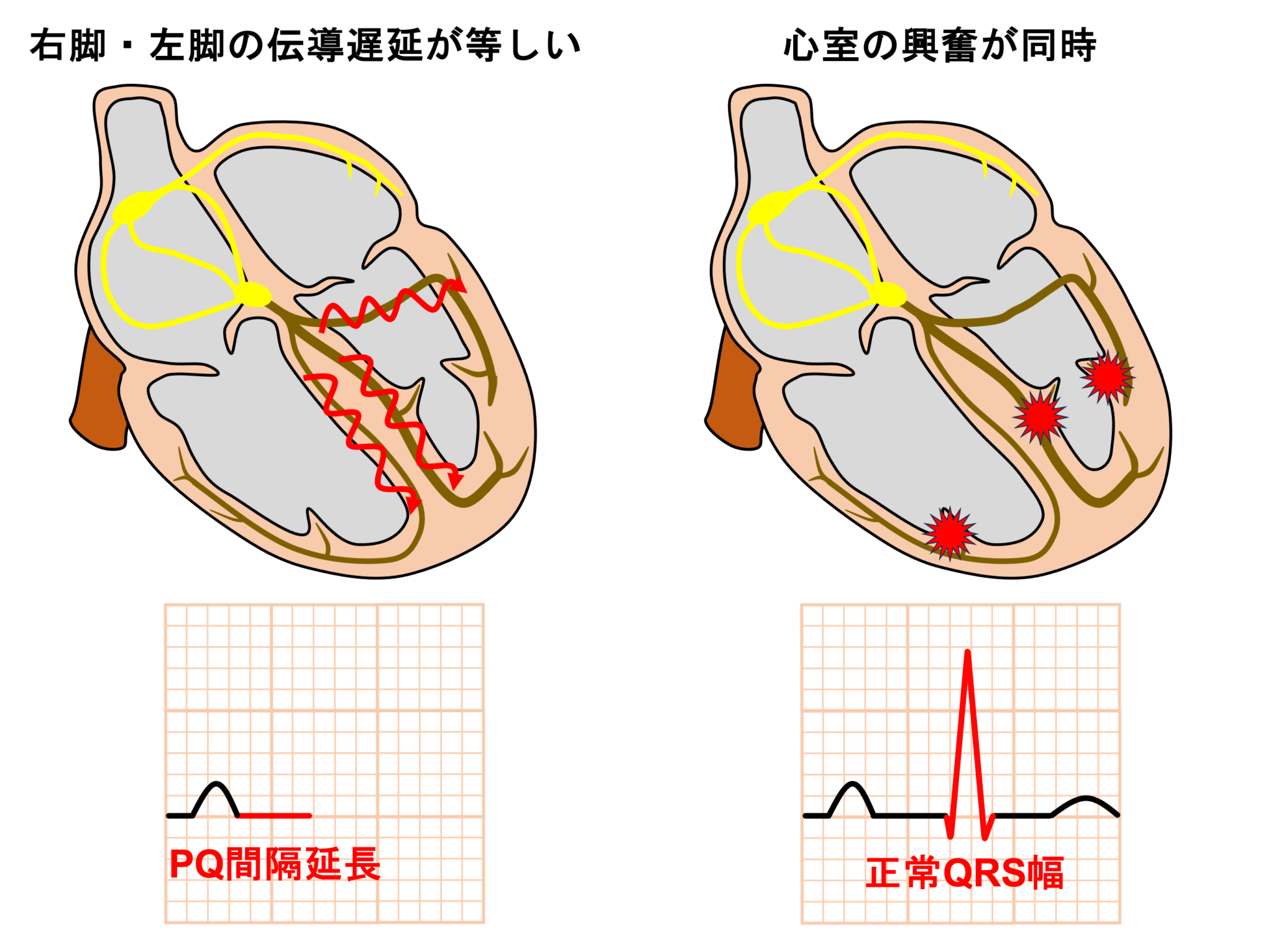 pseudo‐supernormal conductionとは？ | 心電図.com