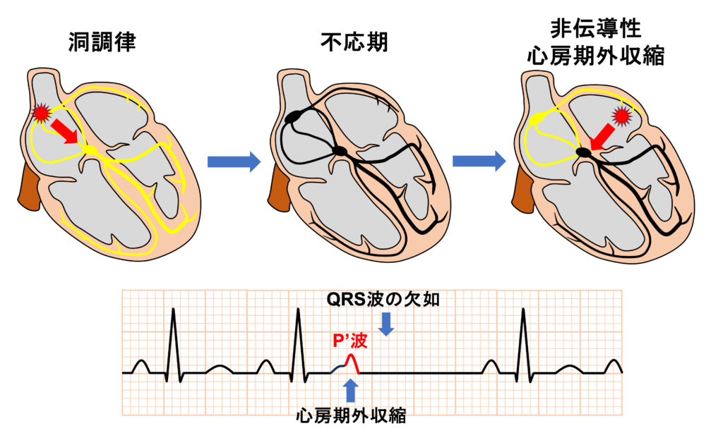 非伝導性心房期外収縮とは? | 心電図.com