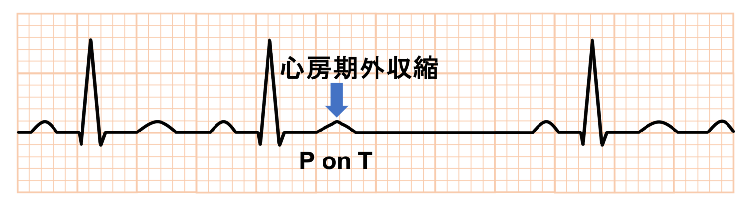 非伝導性心房期外収縮とは? | 心電図.com