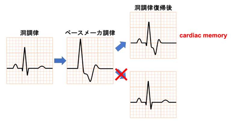 cardiac memoryとは？ | 心電図.com
