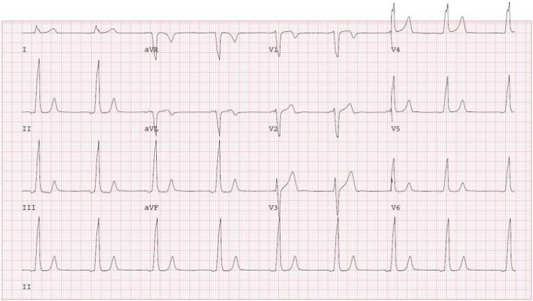 異常Q波とは？ | 心電図.com