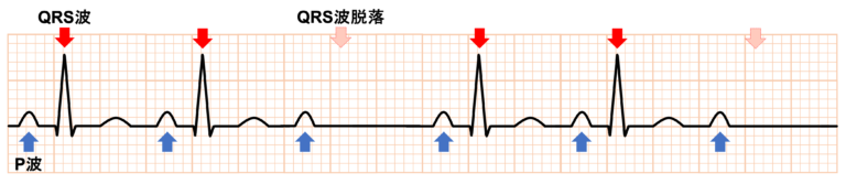 MobitzⅡ型Ⅱ度房室ブロックとは？ 心電図com
