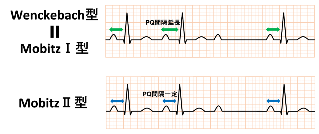 Wenckebach現象とは？ | 心電図.com