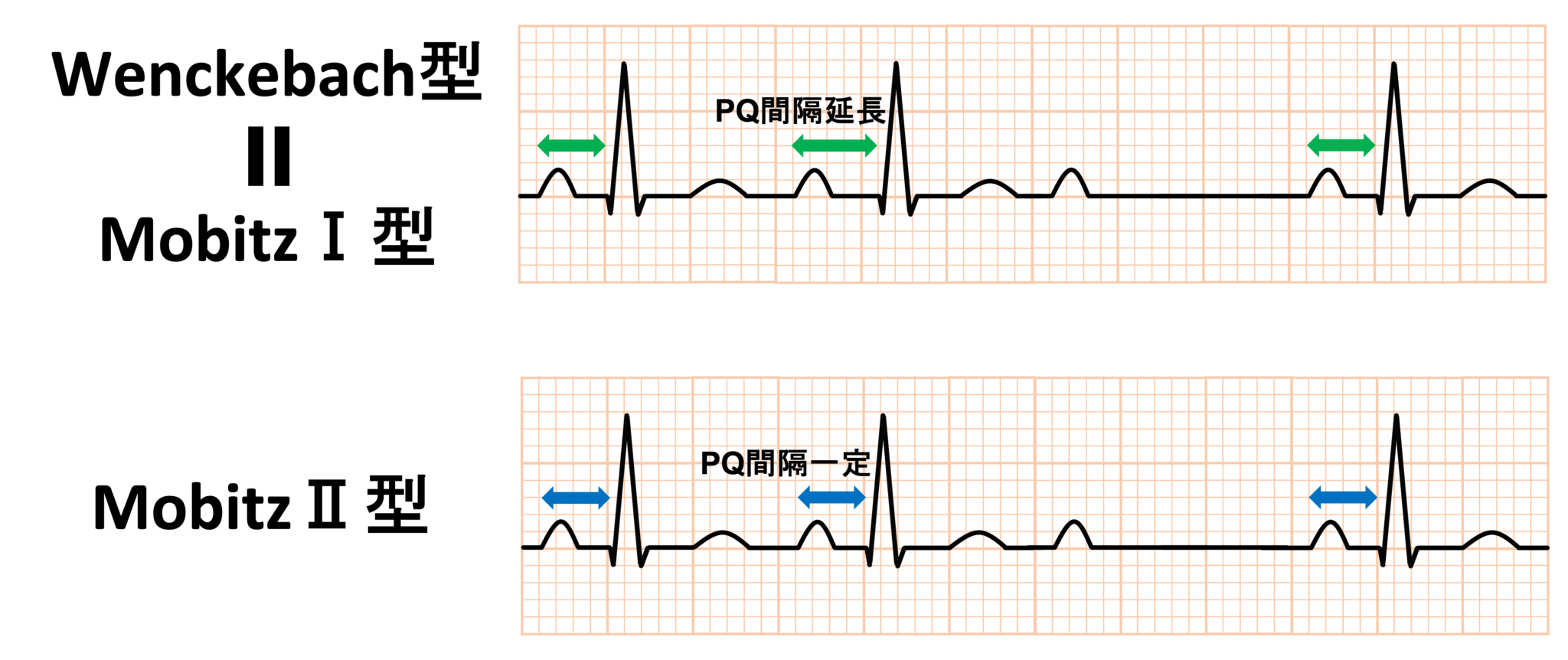 Wenckebach現象とは？ | 心電図.com