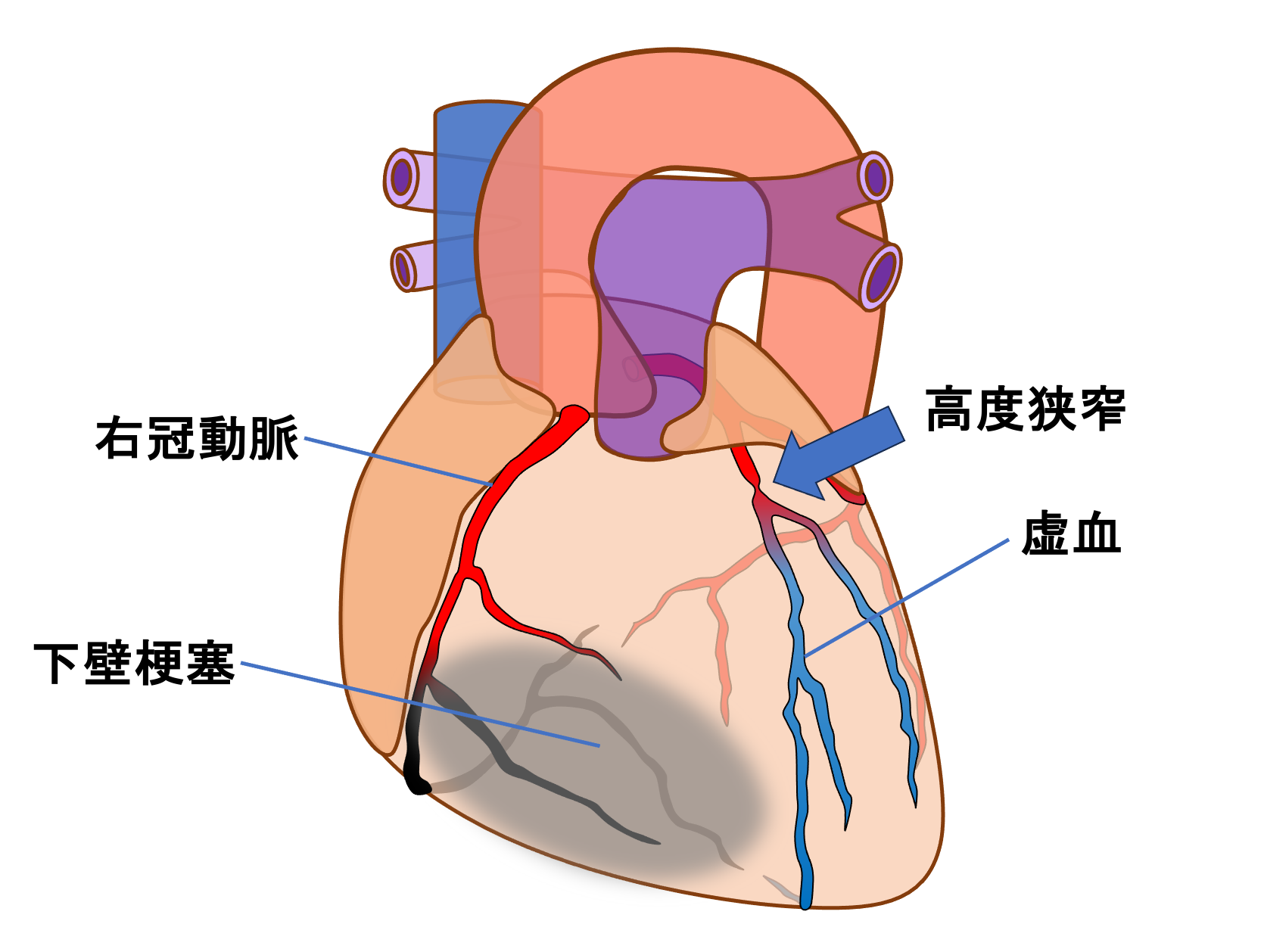 Aslanger’s patternとは？ | 心電図.com
