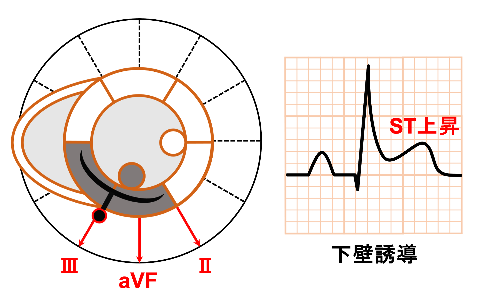 下壁心筋梗塞とは? | 心電図.com