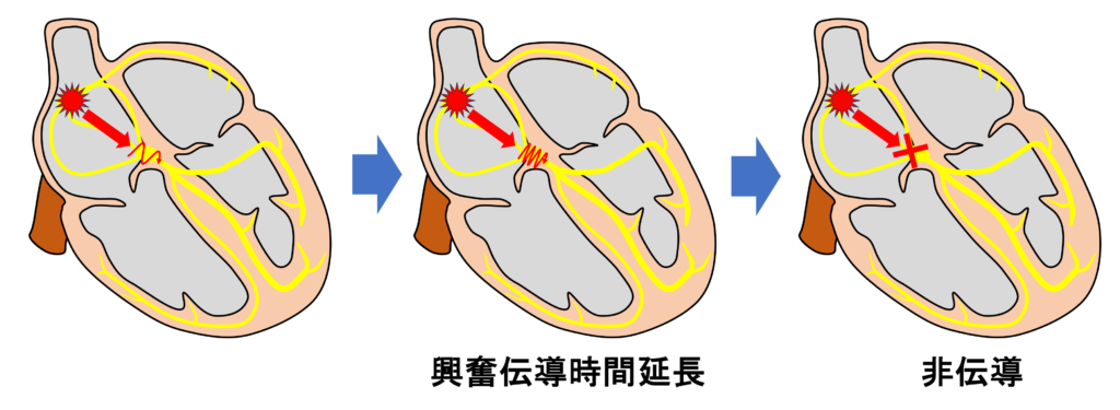 Wenckebach現象とは？ | 心電図.com
