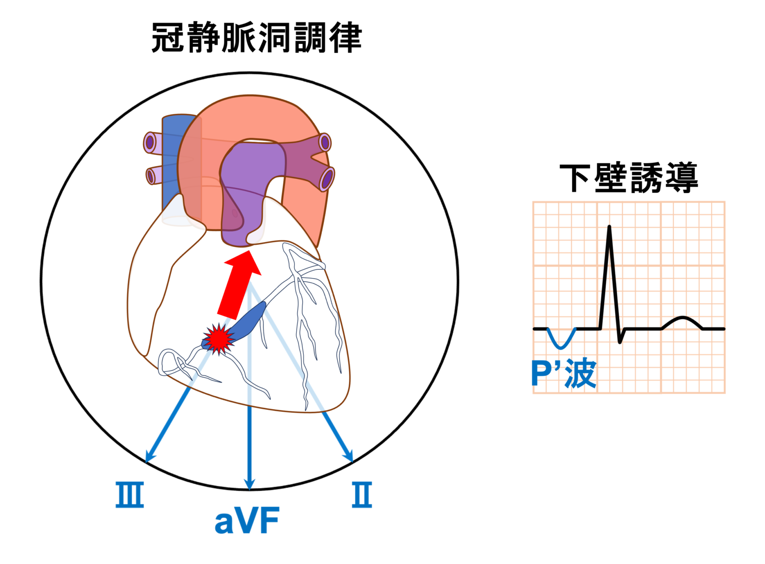 冠静脈洞調律とは？ | 心電図.com