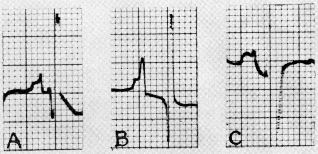 左房調律とは？ | 心電図.com