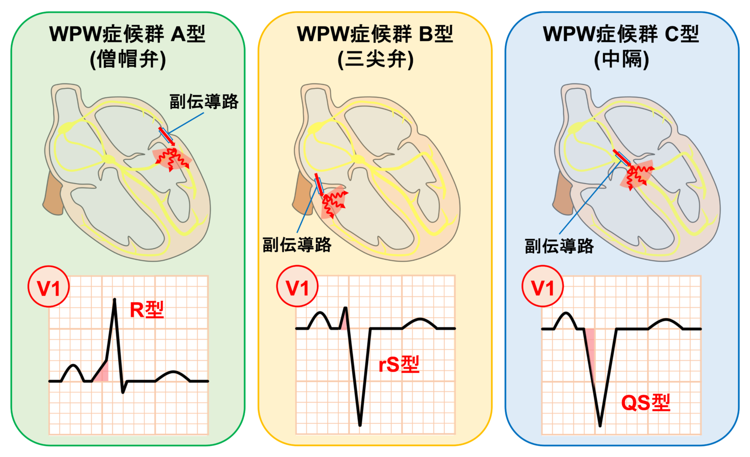 WPW症候群とは？ | 心電図.com