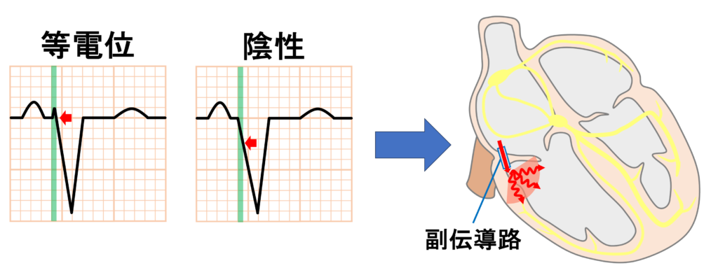 EASY-WPWとは? | 心電図.com