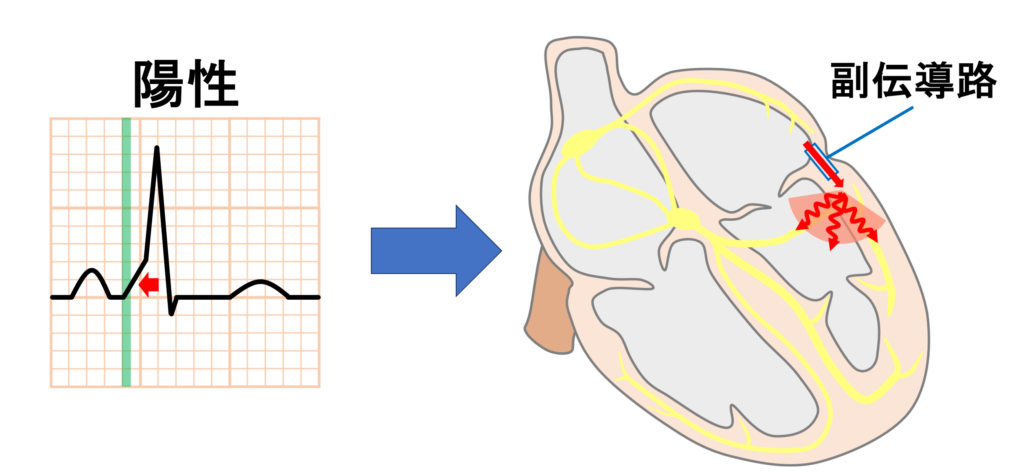 EASY-WPWとは? | 心電図.com
