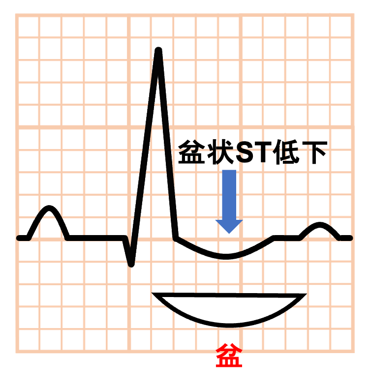 ジギタリス効果とは? | 心電図.com