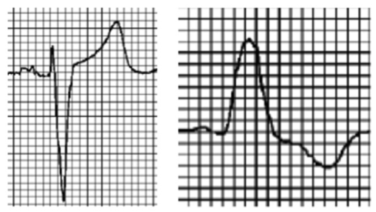 appropriate discordanceとは？ | 心電図.com