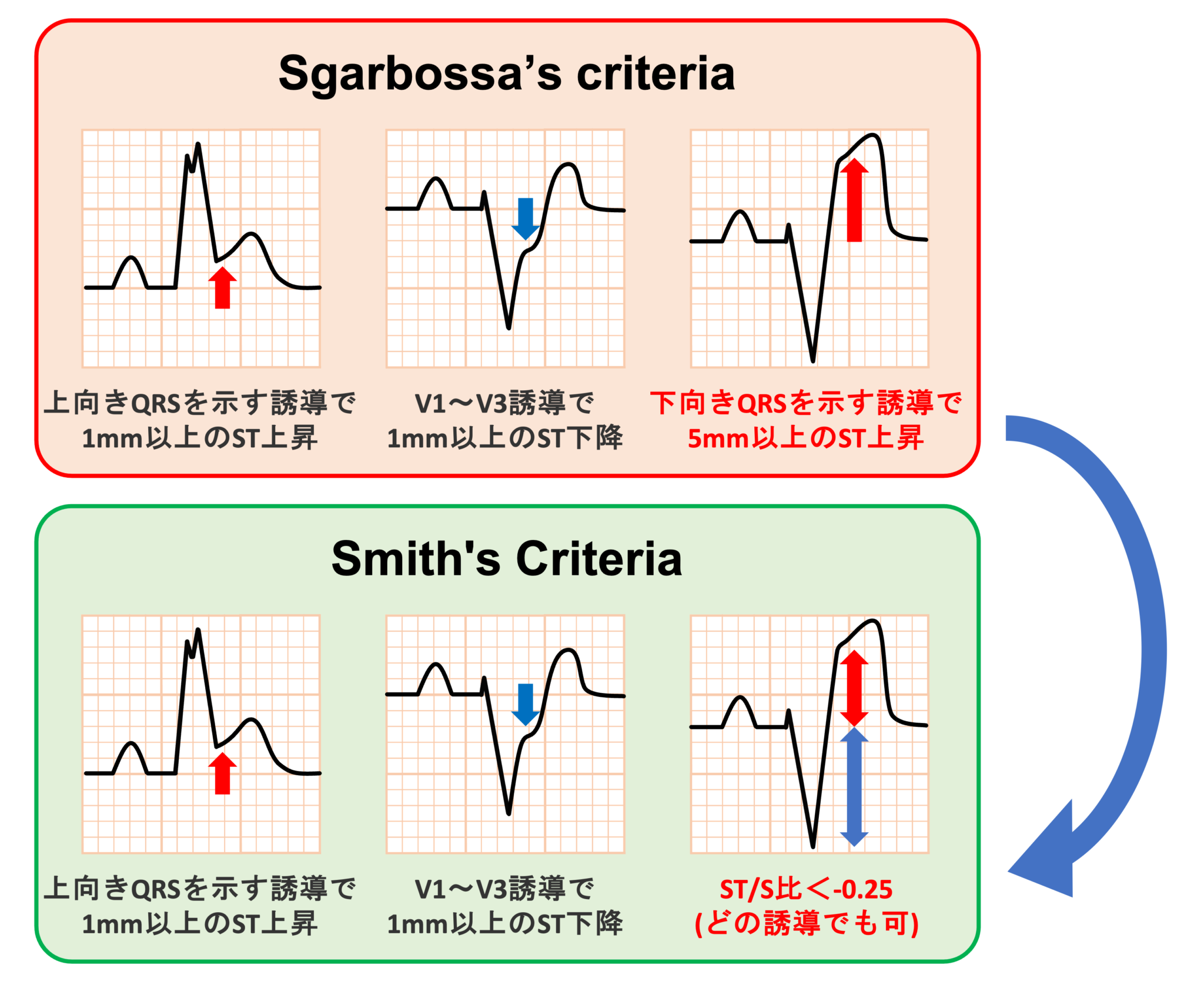 Smith’s Criteriaとは？ | 心電図.com