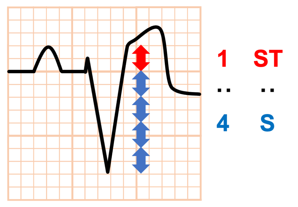 Smith’s Criteriaとは？ | 心電図.com