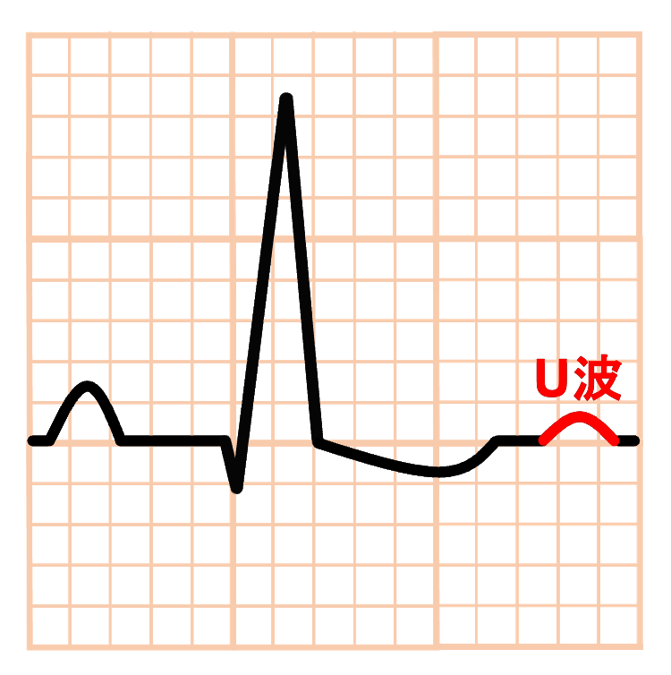 ジギタリス効果とは? | 心電図.com