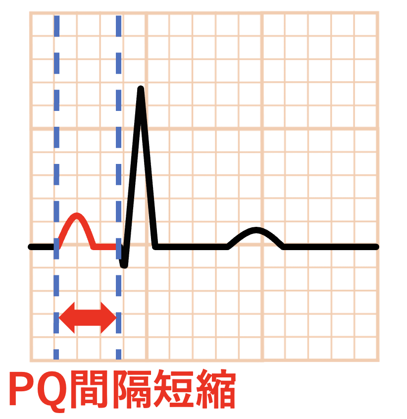 LGL症候群とは？ | 心電図.com