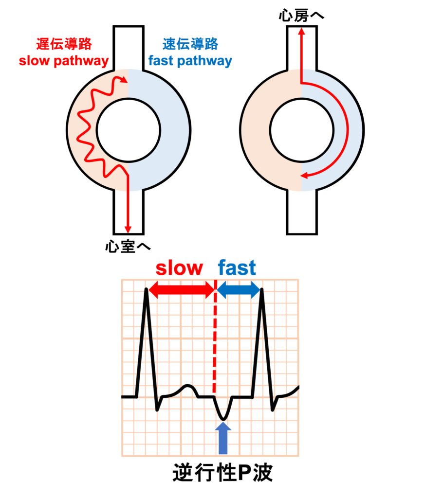 fast-slow AVNRTとは？ | 心電図.com