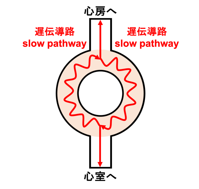 slow-slow AVNRTとは？ | 心電図.com