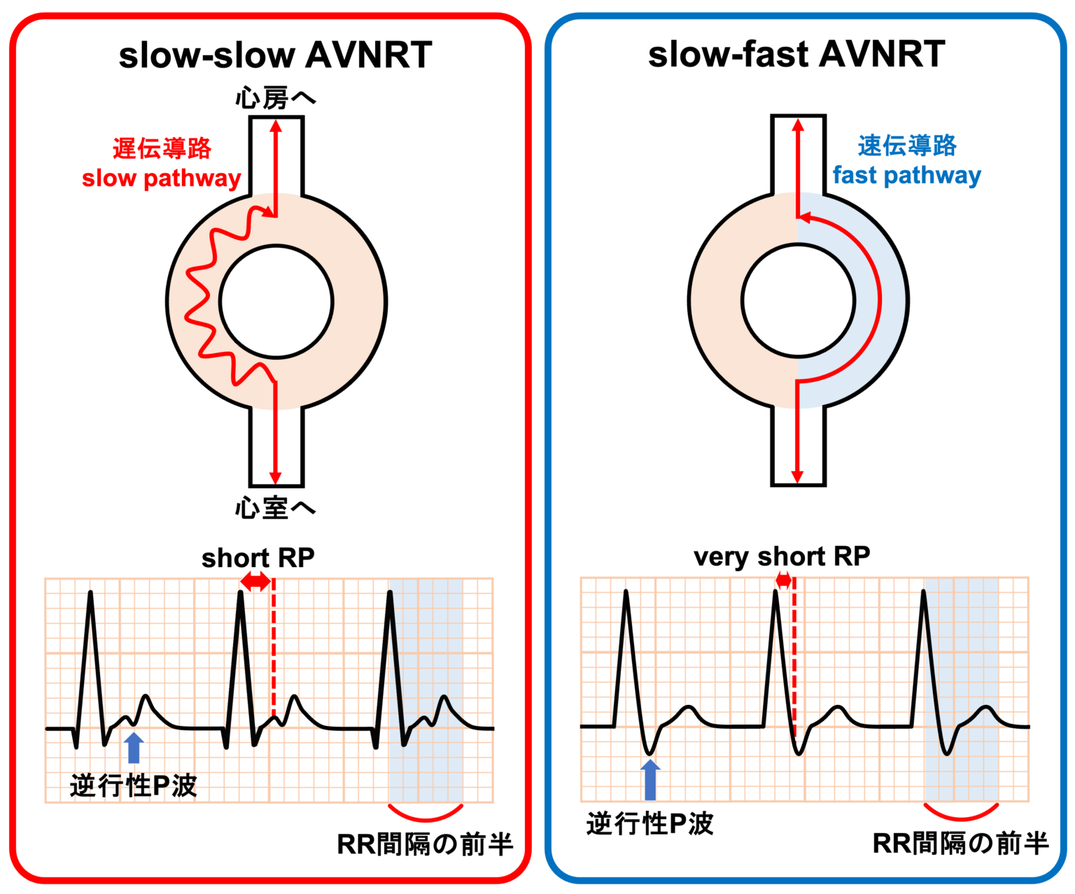 slow-slow AVNRTとは？ | 心電図.com