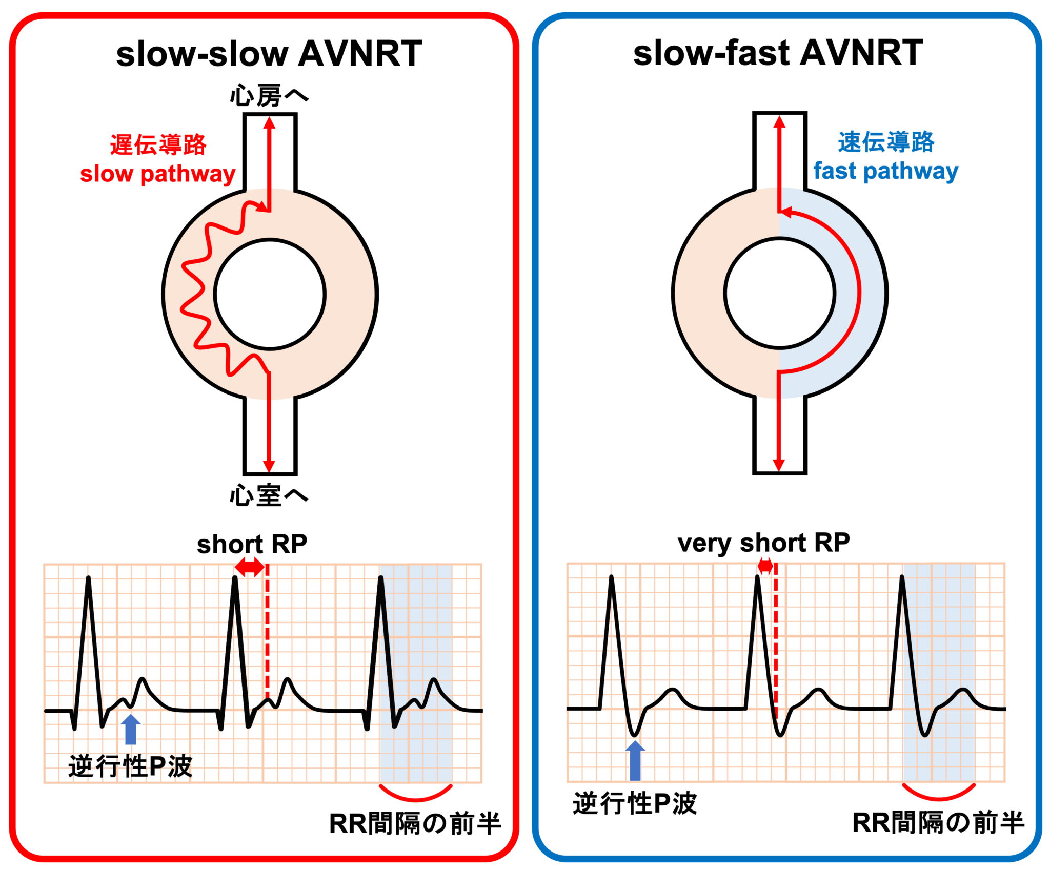 slow-slow AVNRTとは？ | 心電図.com