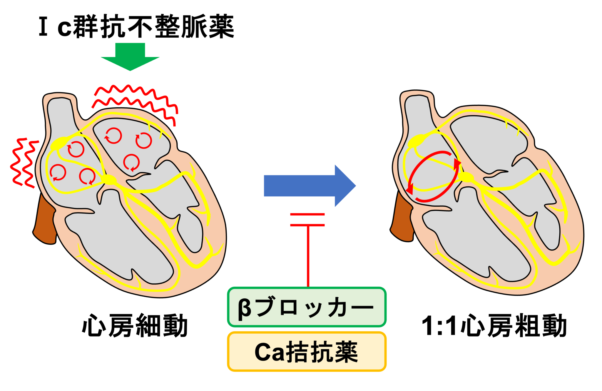 Ⅰc Flutterとは? 心電図com