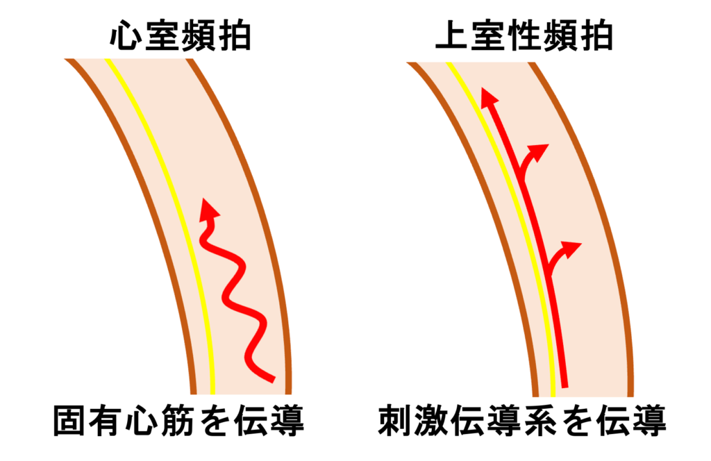 Pava criteriaとは？ | 心電図.com