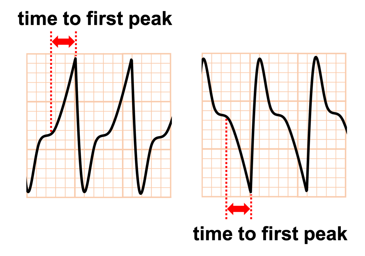 Basel algorithmとは？ | 心電図.com