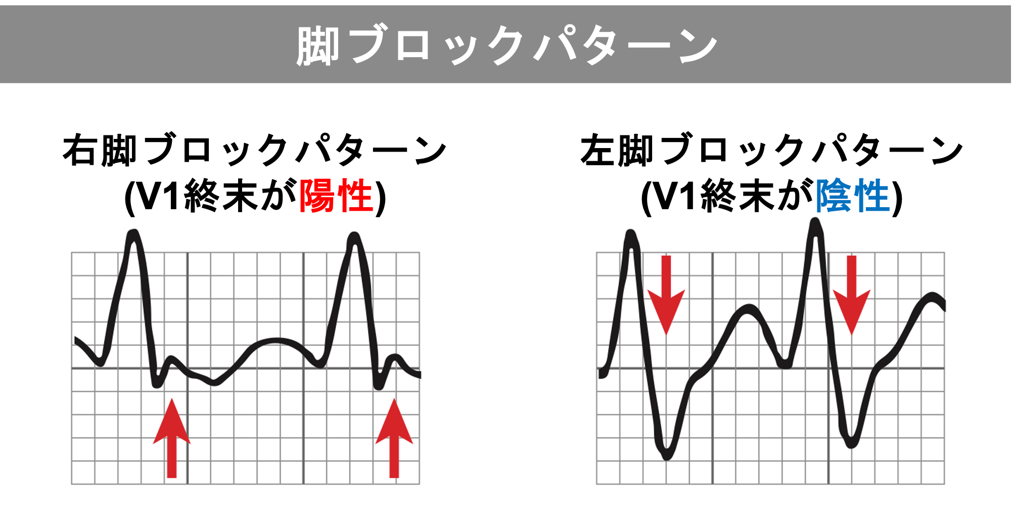 VTとSVTの鑑別とは？ | 心電図.com