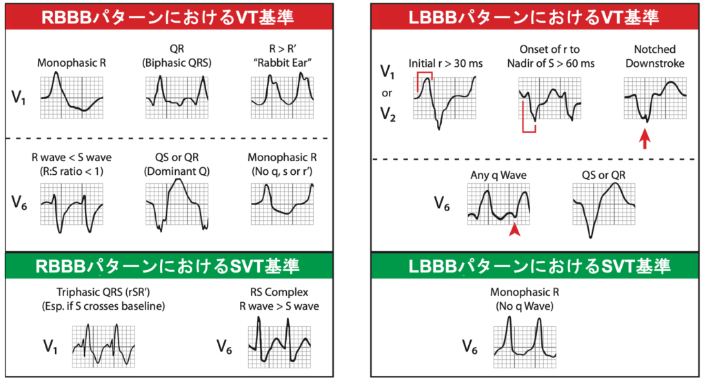 VTとSVTの鑑別とは？ | 心電図.com