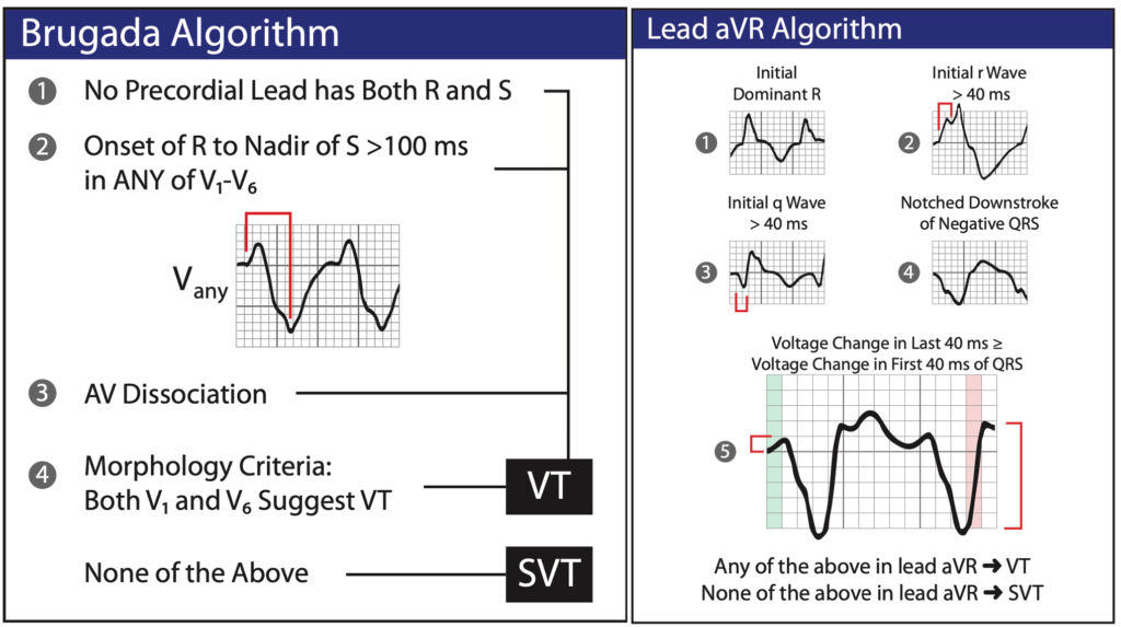 VTとSVTの鑑別とは？ | 心電図.com