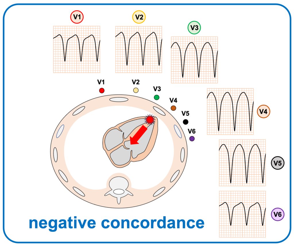 concordanceとは？ | 心電図.com