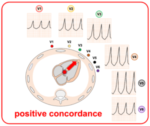concordanceとは？ | 心電図.com