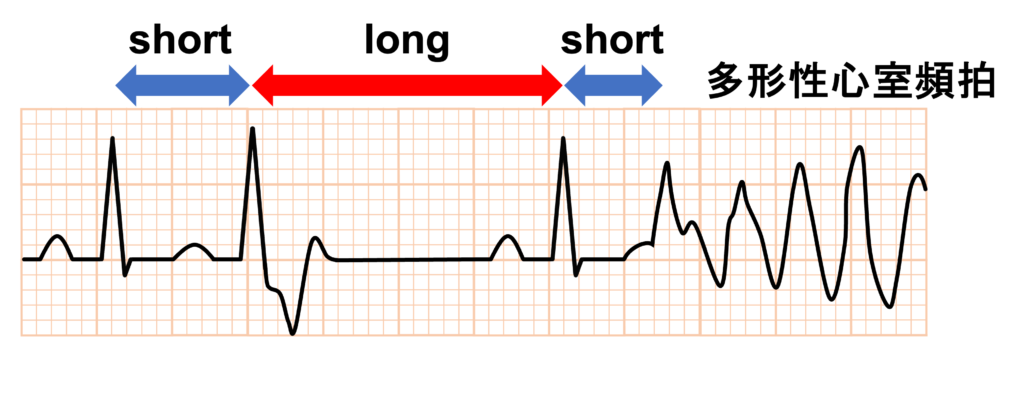short-long-short sequenceとは？ | 心電図.com
