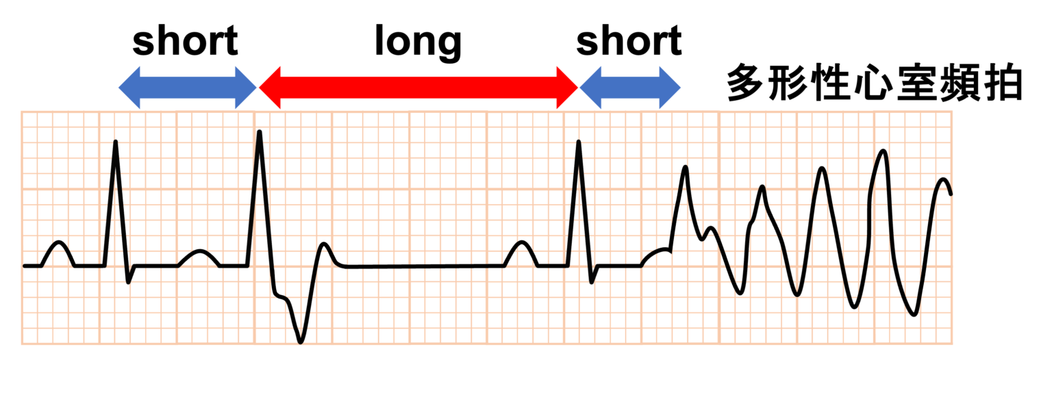 short-long-short sequenceとは？ | 心電図.com
