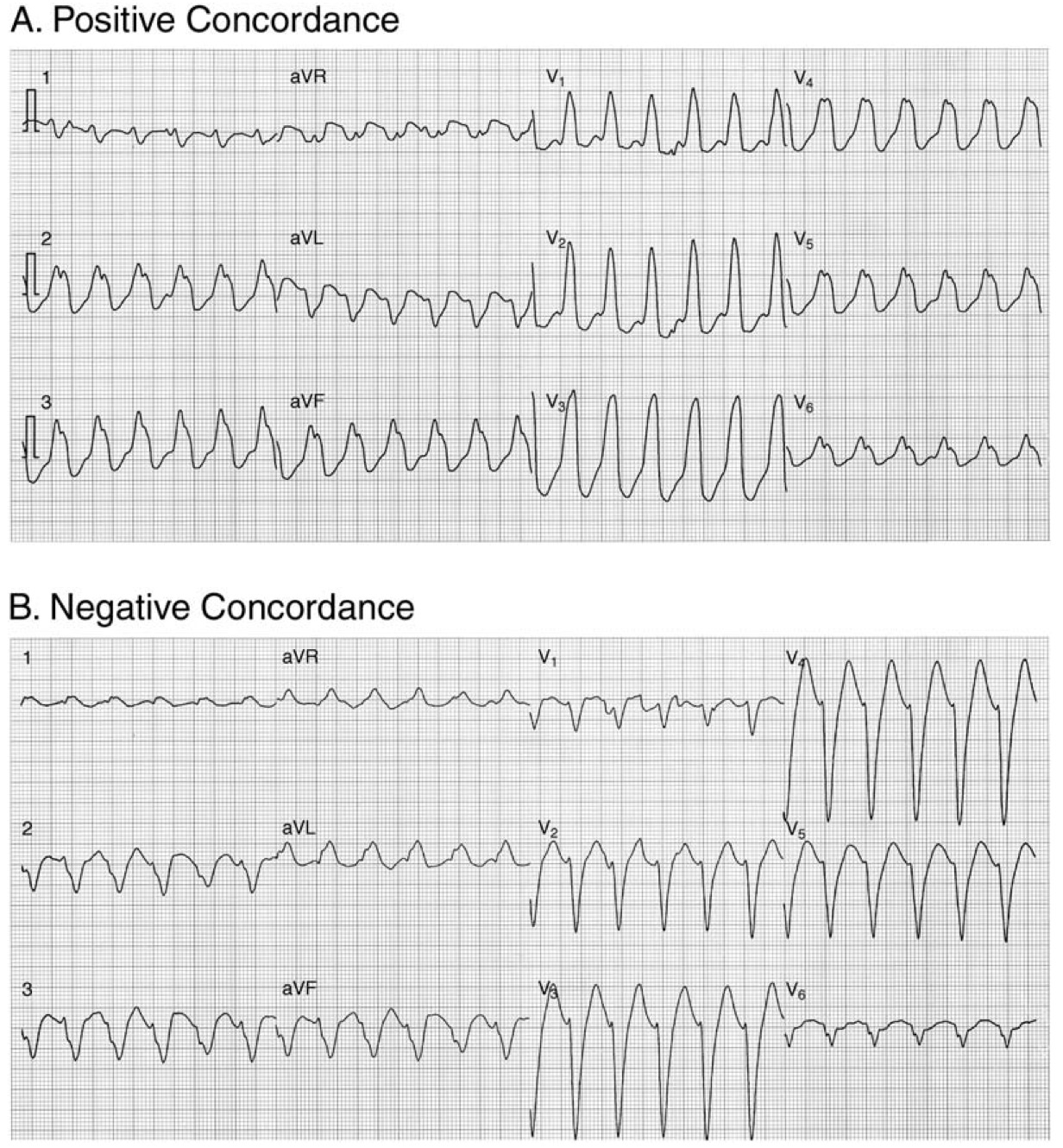 concordanceとは？ | 心電図.com