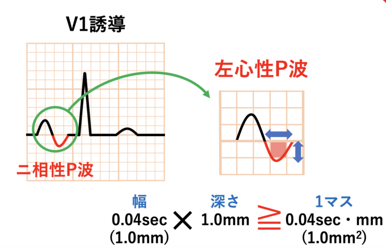 P terminal forceとは？ | 心電図.com