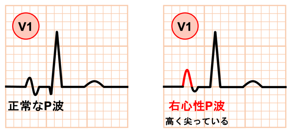 右心性P波とは? | 心電図.com