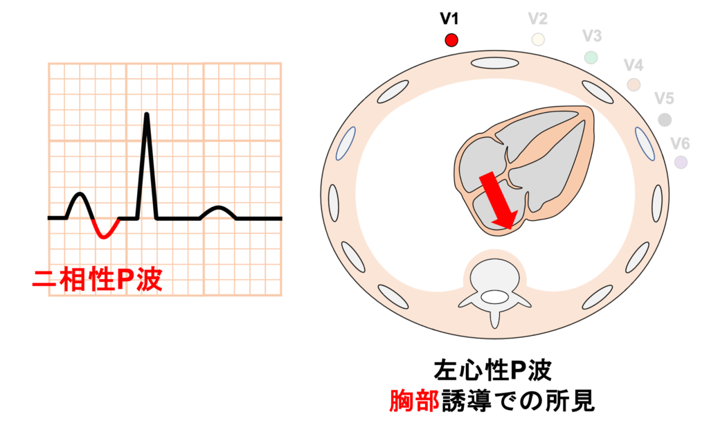 P terminal forceとは？ | 心電図.com