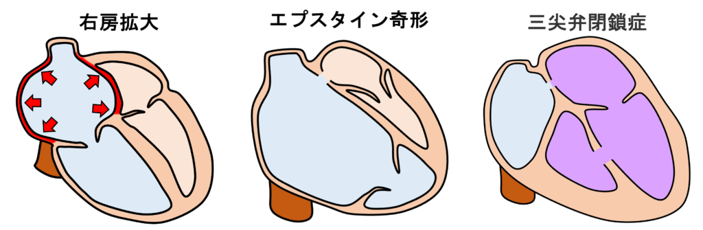 Himalayan P wavesとは？ | 心電図.com