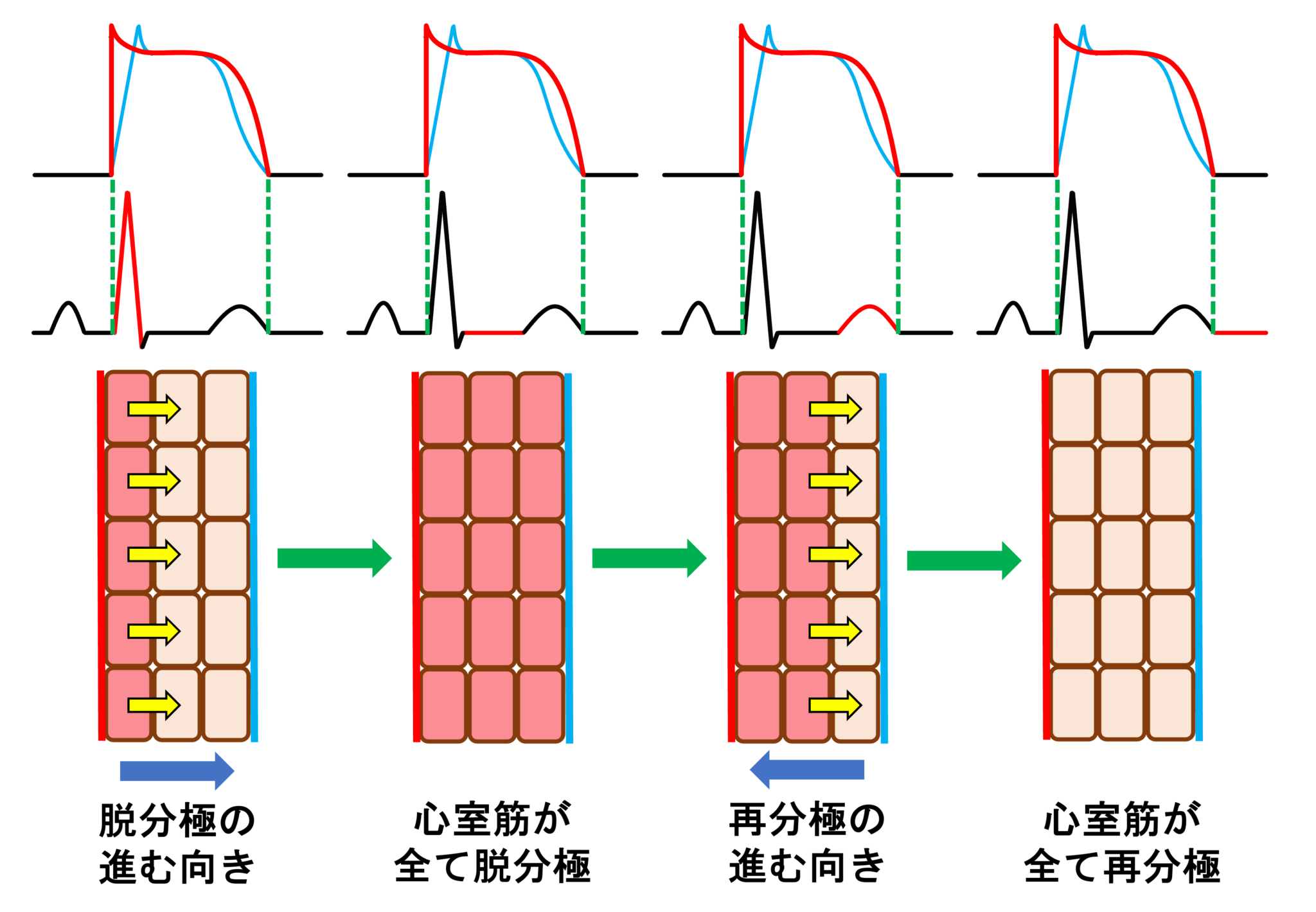 ventricular gradientとは? | 心電図.com
